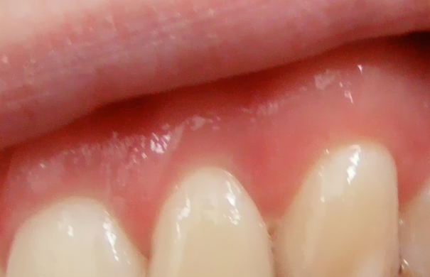 Zahnfleischentzündung, Gingivitis | Medizin-Lexikon | Lecturio