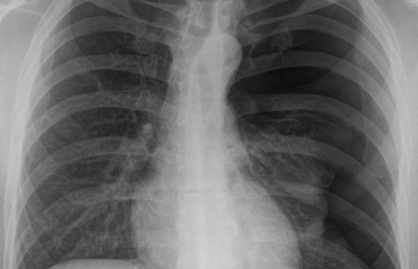 Pneumothorax, Lungenkollaps | Medizin-Lexikon | Lecturio