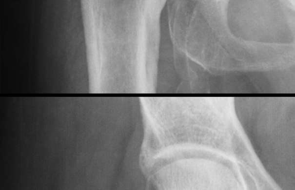 Koxarthrose, Hüftgelenkarthrose | Medizin-Lexikon | Lecturio