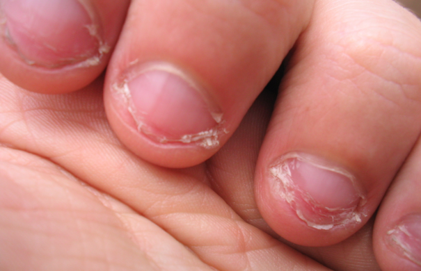 Nagelpflege | Medizinisches Wissen von A-Z | Online Lernen mit Lecturio