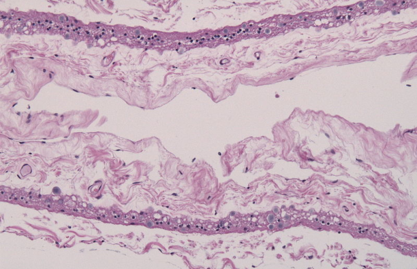 Zyste | Medizin-Lexikon | Online Lernen mit Lecturio