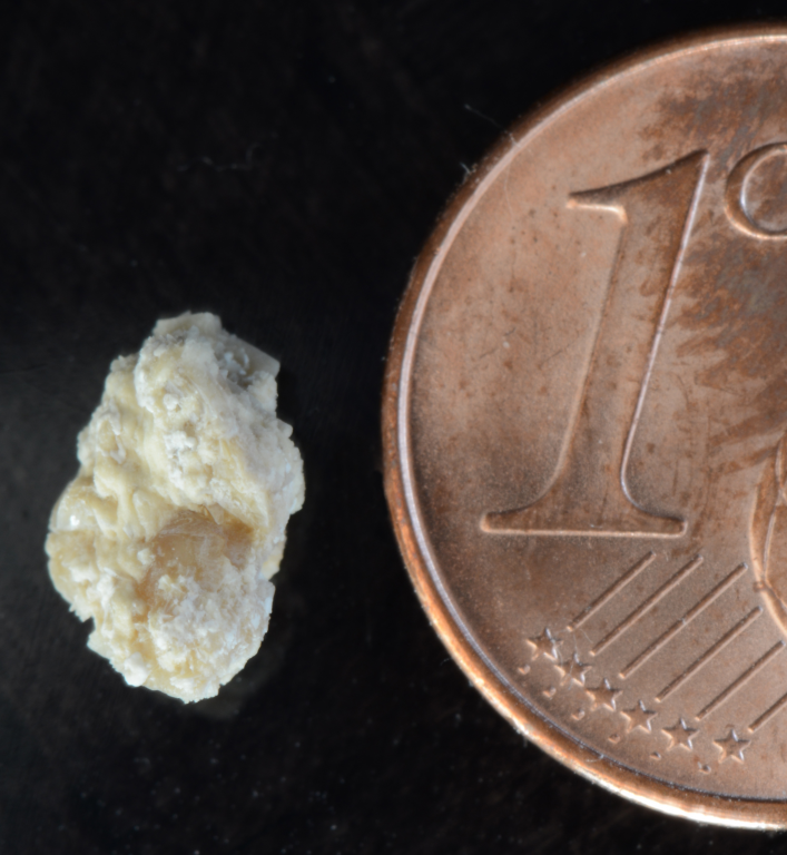 Nephrolithiasis, Nierensteinkrankheit | Medizin-Lexikon