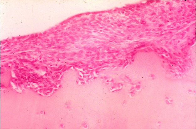 Rheumatoide Arthritis & Morbus Still