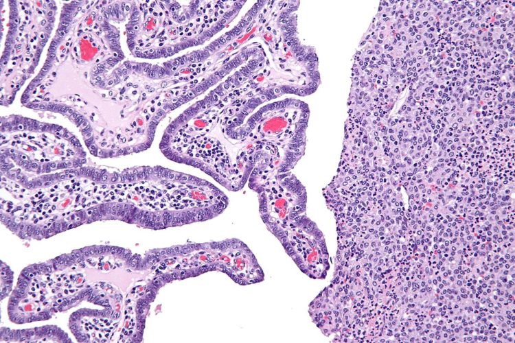 Salpingitis — Diagnosis and Treatment | Online Medical Library