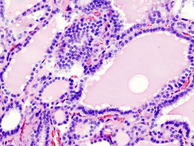 Hyperthyroidism and Graves´ Disease (Basedow Disease) | Lecturio