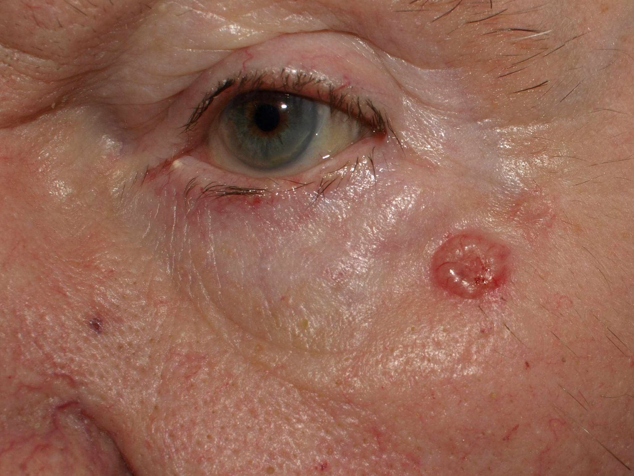 Basal Melanoma Skin Cancer Basal Melanoma Skin Cancer